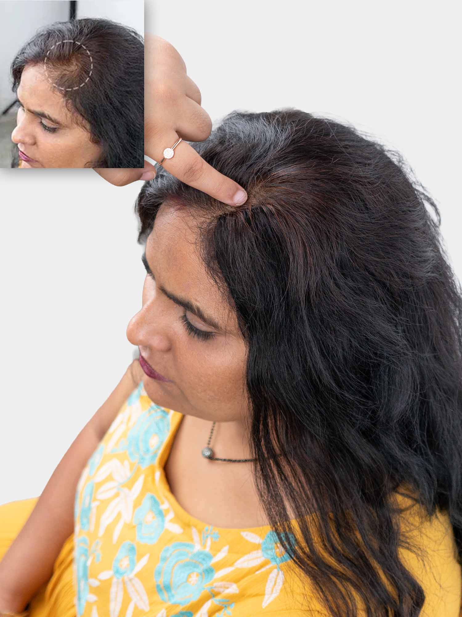 Invisible Spot Cover-Up Hair patch | Hair Thinning Solutions